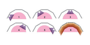 Healite II™ – Cynosure Lutronic Australia