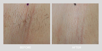 Clarity II – Cynosure Lutronic Australia