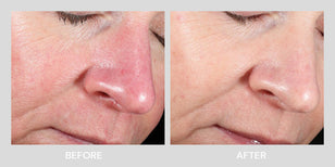 DermaV – Cynosure Lutronic Australia