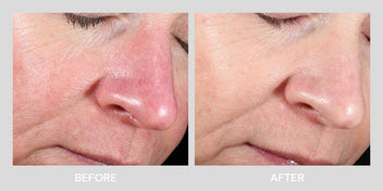 DermaV – Cynosure Lutronic Australia