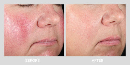 DermaV – Cynosure Lutronic Australia