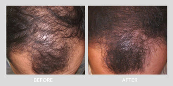 Healite II™ – Cynosure Lutronic Australia