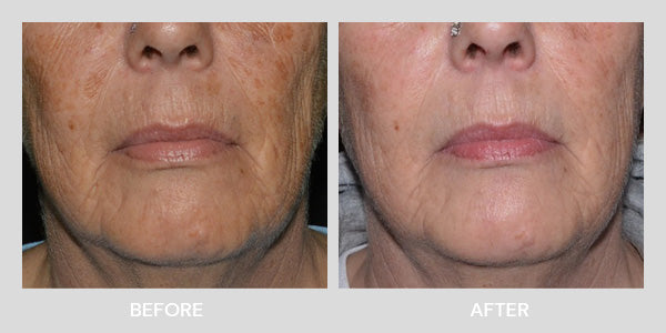 ULTRA™ – Cynosure Lutronic Australia